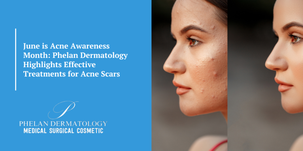 June is Acne Awareness Month: Phelan Dermatology Highlights Effective ...